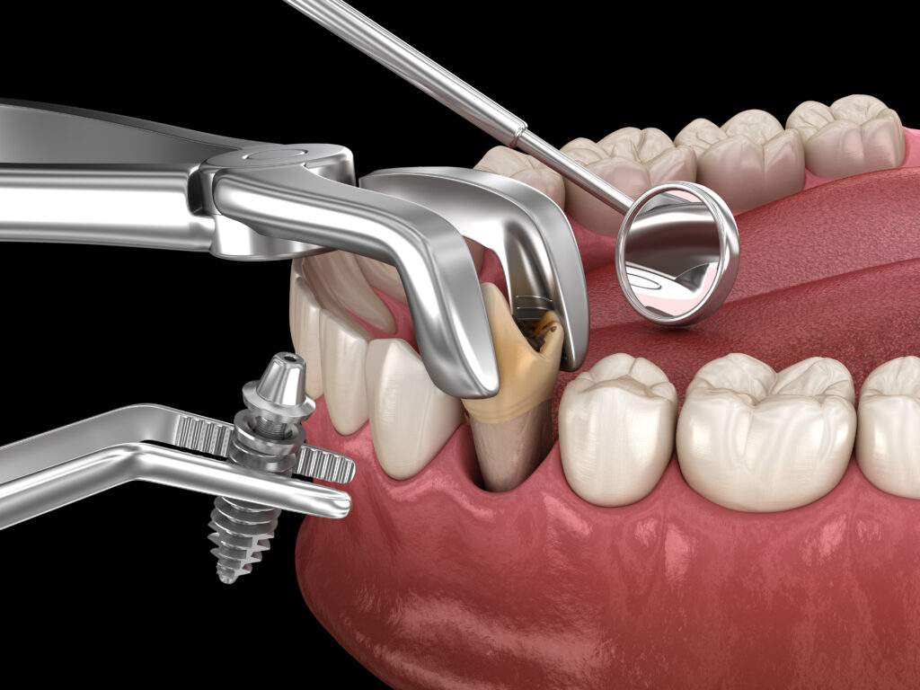Replacing Missing Teeth With Prosthetics | Richardson, TX